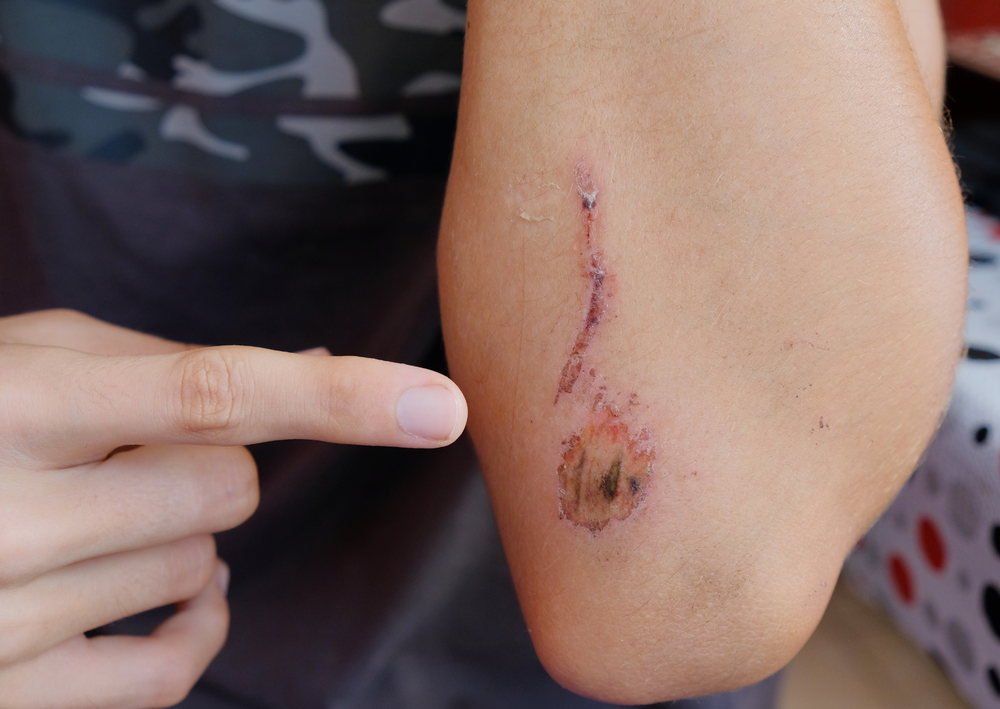 Supporting Wound Healing with LED Red Light Therapy