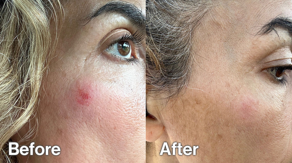 Red Light Therapy Device | LUMEBOX